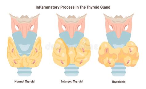 Thyroiditis Thyroid Inflammation Thyroid Gland Produces Abnormal