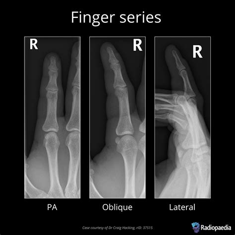 Normal Index Finger X Ray At Hunter Wang Blog