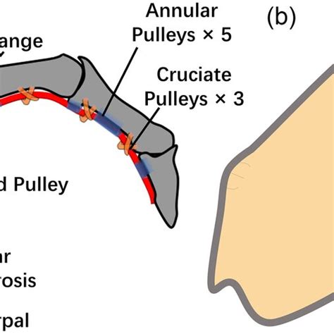 tendon routing path design a trigger finger phenomenon b tendon