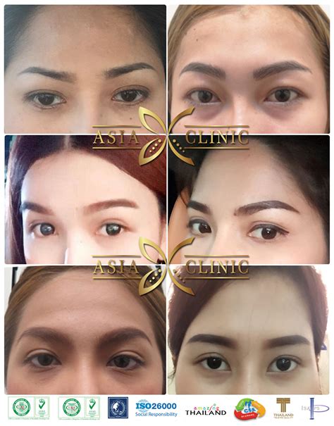 Double Eyelid Surgery Before And After Photos