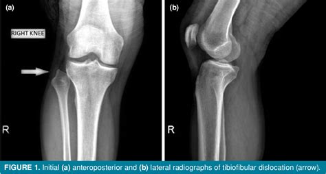 Figure 1 From Proximal Tibiofibular Dislocation Accompanied By Bucket
