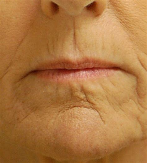 Dynamic Vs Static Wrinkles What Are The Treatments