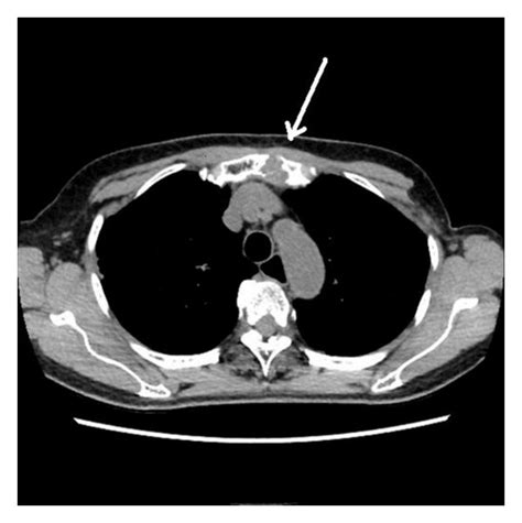 Computed Tomography Scans Of The Mass The Arrow Indicates The Sternal