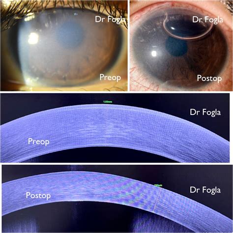 Rajesh Fogla On Linkedin Dmek For Ched Congenital Hereditary Endothelial Dystrophy From