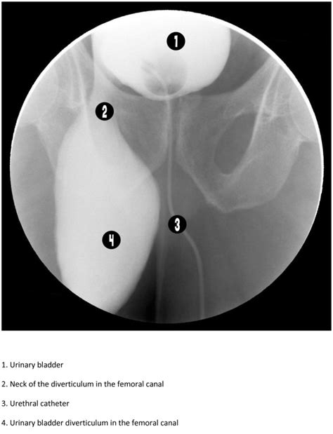 Retrograde Urethrocystogram Showing The Urinary Bladder Diverticulum Download Scientific