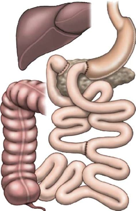 Laparoscopic Sleeve Gastrectomy With Duodeno Jejunal Bypass Download