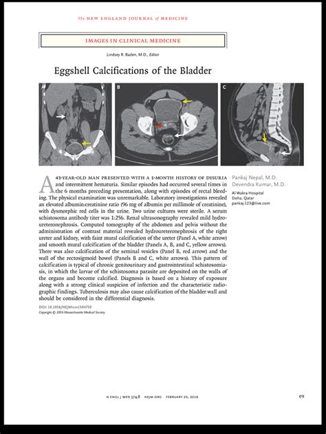 Pdf Eggshell Calcifications Of The Bladder