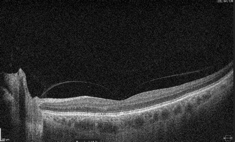 Ai Oct Optic Disc Analysis For Assessing Risk Of Glaucoma