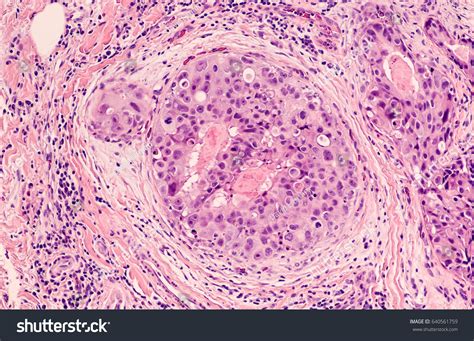 Nuclear Grade 3 Ductal Carcinoma Grade 2 Tumor Score Zvsr