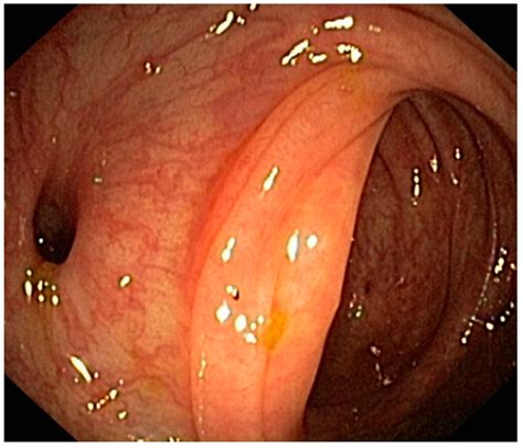 When To Perform A Colonoscopy In Diverticular Disease And Why A
