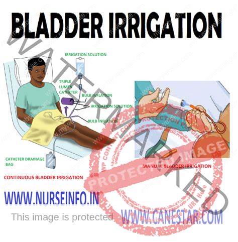 Bladder Irrigations Procedure And Purpose Over