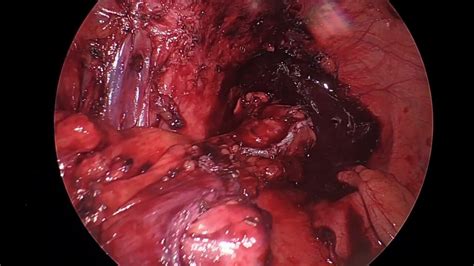 Laparoscopic Sigmoid Colectomy By Nezar Jrebi Md And Jay Redan Md Jandj Medtech