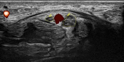 Peripheral Nerves Ultrasound