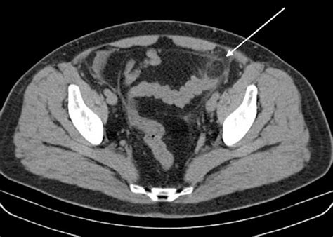 Epiploic Appendagitis Semantic Scholar