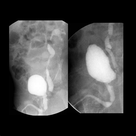 Posterior Urethral Valve Pacs Posterior Urethral Valve Pacs