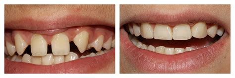 Composite Bonding Baker Street Dental