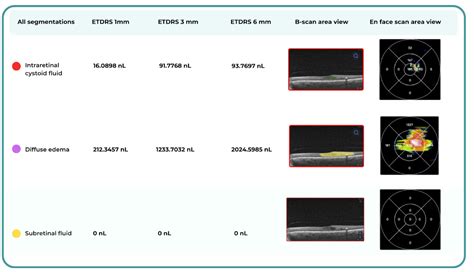 New Ai Powered Fluid And Ga Quantification Features For Oct Scan Analysis Review Of Optometric