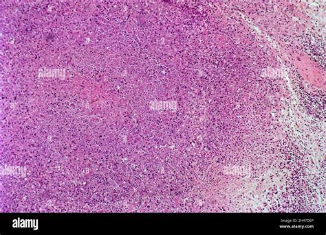 Miliary Tuberculosis Histology