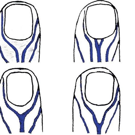 A Level Of Amputation Hirase Classification B Level Of