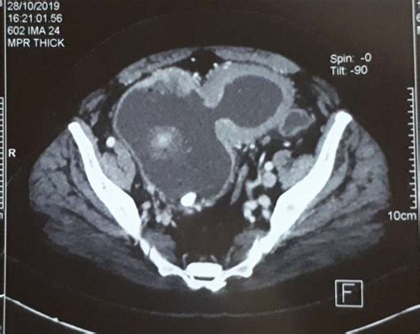 Ct Scan Of The Bladder 2 Months Before The Rupture Showing Bladder