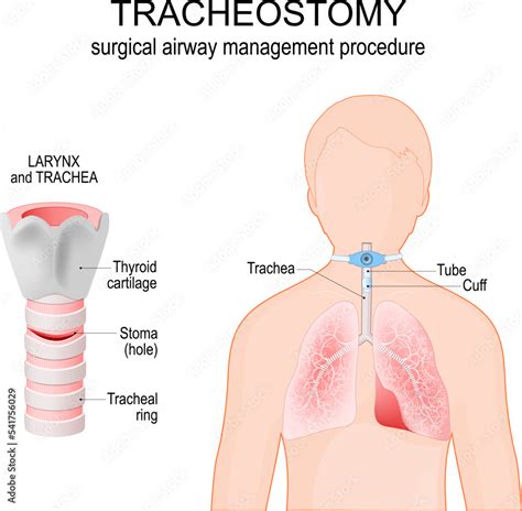 Tracheostomy And Ecmo At Maddison Cadman Blog