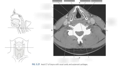 Axial Ct Of Larynx With Vocal Cords And Arytenoid Cartilages Diagram