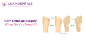 Corn Removal Surgery Explained When And Why You Need It
