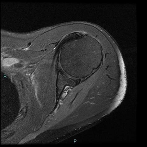Suprascapular Notch Mri