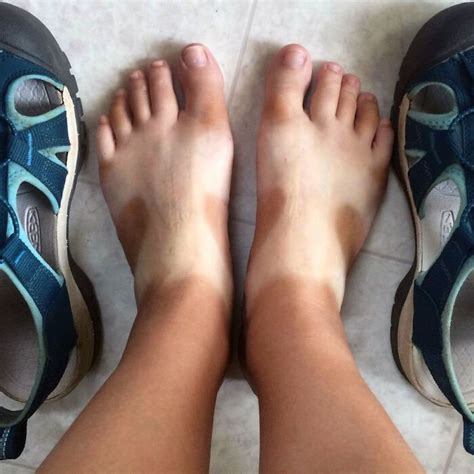 50 Times People Posted Their Embarrassing Sunbathing Fails So You Can