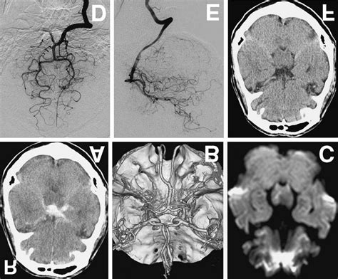 Case 1 A Head Computed Tomography Ct Scan On Admission Showing