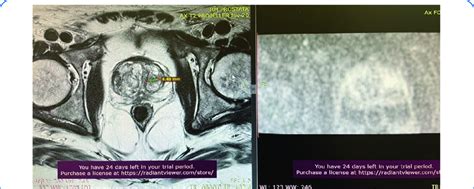 Two Mpmri Sequences Of Prostate With A Pi Rads 4 Lesion Of The Download Scientific Diagram