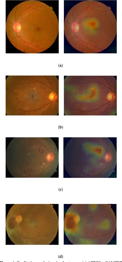 Figure 6 From A Regression Based Approach To Diabetic Retinopathy Diagnosis Using Efficientnet