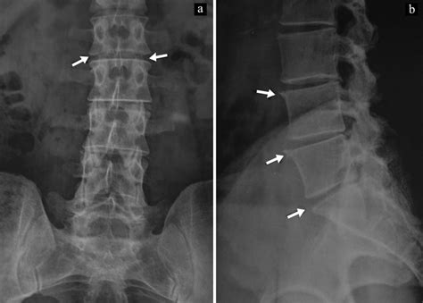 Radiograph Of Lumbar Spine Ofmr Y Anteroposterior And Lateral View In Download Scientific