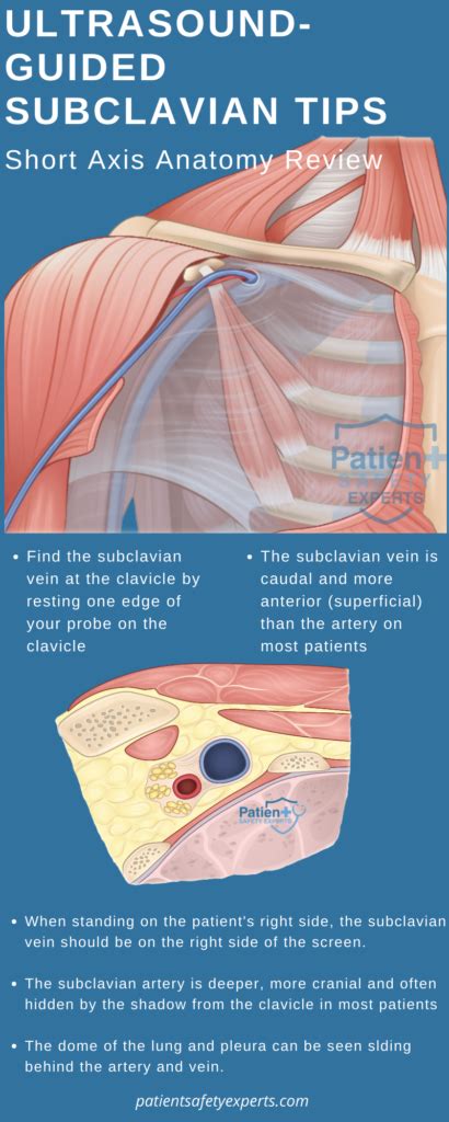 Ultrasound Guided Subclavian Central Line Placements Patient Safety