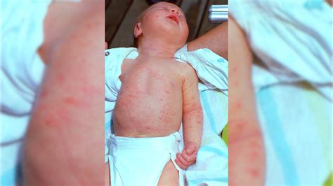 Acne Neonatorum Vs Erythema Toxicum