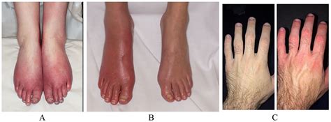 Vascular Disease Patient Information Page Erythromelalgia Elizabeth