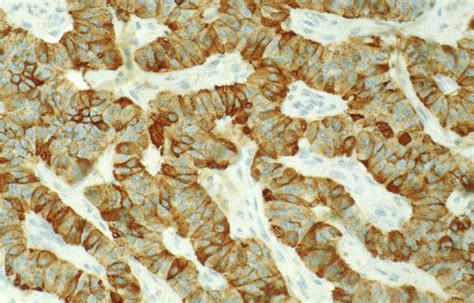 Lung Cancer Light Microscopy Stock Image C0618586 Science Photo Library