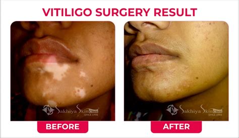 Vitiligo Surgery Sakhiya Skin Clinic