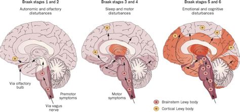 A New Theory Of Parkinsons Disease The Science Of Parkinsons