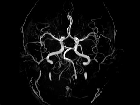 Brain Lesion With Multiband Sense Philips Mr Body Map