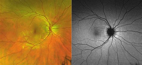 Winning Ors Case Report Describes Blind Spot Enlargement
