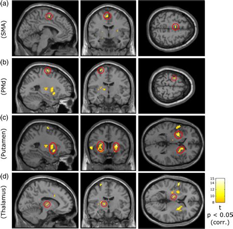 Cortical And Subcortical Brain Areas In Which Bold‐activation