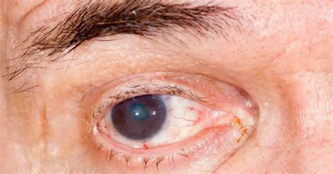Episcleritis Causes Know The Triggers