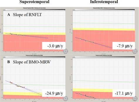 Representative Case Showing The Rate Of Thinning Of Retinal Nerve Fiber Download Scientific