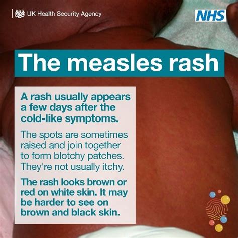 Nhs Launches Catch Up Campaign For Missed Mmr Vaccines Issa Medical