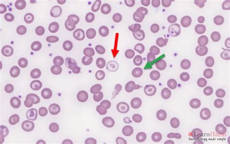 Dimorphic Picture Learnhaem Haematology Made Simple