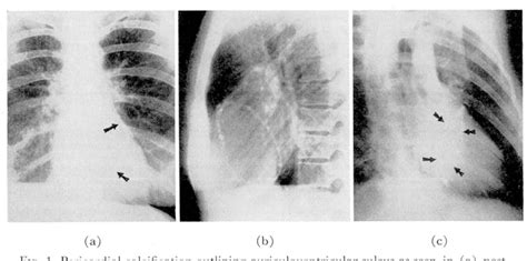 Figure 1 From The Roentgenologic Appearance Of Pericardial Calcification Semantic Scholar