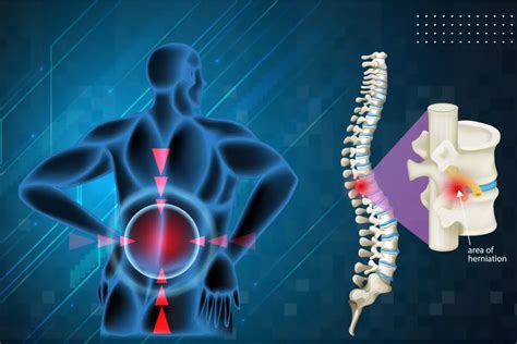 Spinal Cord Disorders Symptoms Causes And Treatment