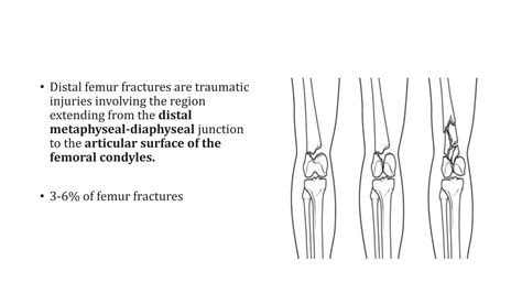 Distal Femur Patella Proximal Tibia Fracture Pptx