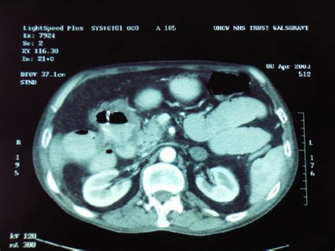 Abdominal Ct Showing A Locally Advanced Tumour In Proximal Transverse Download Scientific